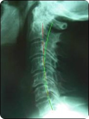 Restoration of an Abnormal Cervical Lordosis Using the DENNEROLL: A CBP ...